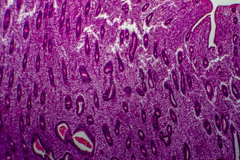 Endometrial Hyperplasia, Light Micrograph Stock Photo - Image of ...
