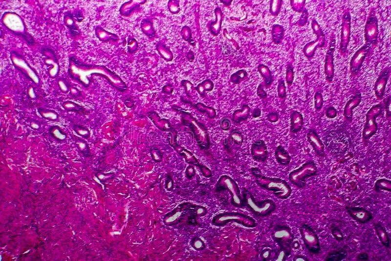 Endometrial Hyperplasia, Light Micrograph Stock Image - Image of uterus ...