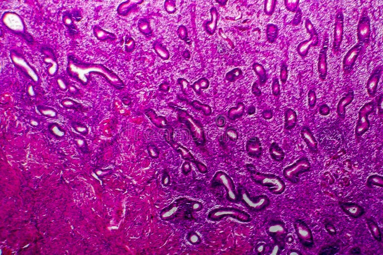 Endometrial Hyperplasia, Light Micrograph Stock Image - Image of uterus ...