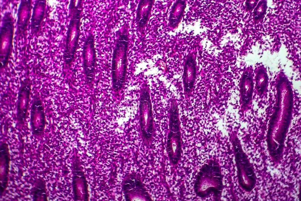 Endometrial Hyperplasia, Light Micrograph Stock Image - Image of ...