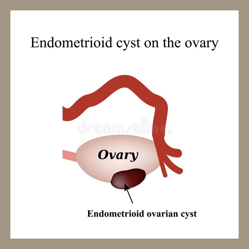 Endometrioid-Zyste Auf Dem Eierstock Endometriosis Eierstock Vektor ...