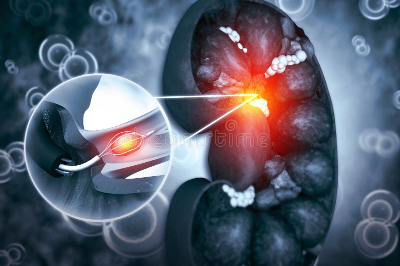 Endoscopic Tattoo Stock Illustrations – 403 Endoscopic Tattoo Stock ...