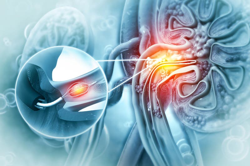 Endoscopic Tattoo Stock Illustrations – 403 Endoscopic Tattoo Stock ...