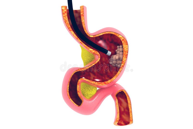 Upper Digestive Tract Endoscopy Illustrations