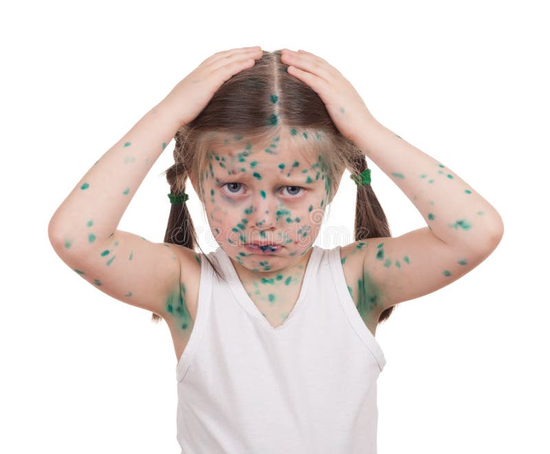 Enfant malade. varicelle photo stock. Image du peau, fille - 30105428