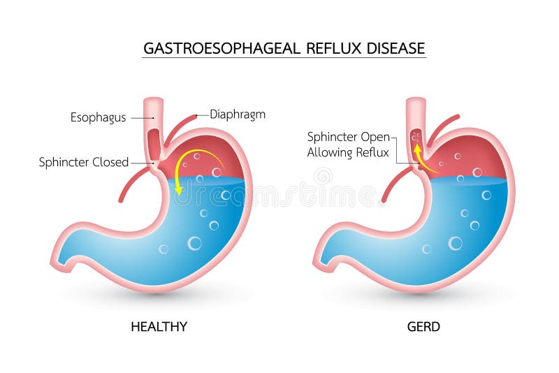 Enfermedad Gerd Del Reflujo Gastroesofágico Ilustración Del Vector
