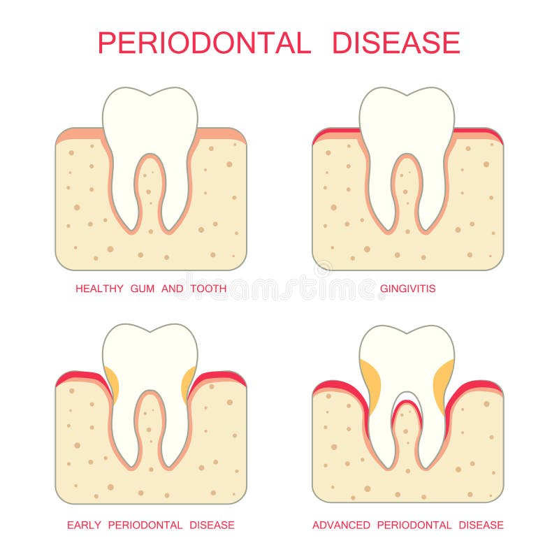 Enfermedad Periodontal O Gingivitis Del Diente De La Incisivo ...