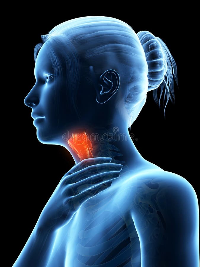 Entflammter Kehlkopf stock abbildung. Illustration von entzündung ...
