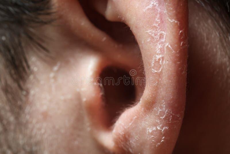 Sun Damaged Skin Stock Photos - Download 161 Royalty Free Photos