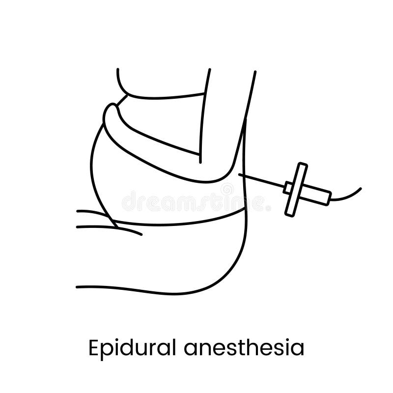 Epidural Stock Illustrations – 311 Epidural Stock Illustrations ...