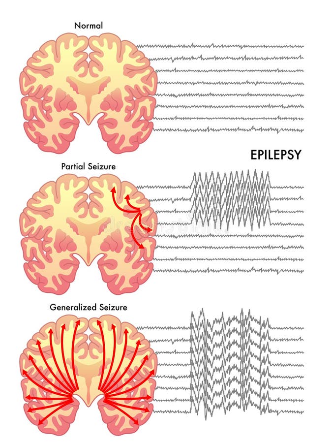 Eeg of normal brain vs epilepsy - gwkera