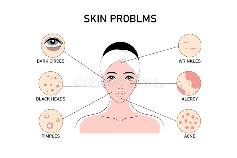 Skin Problems. Acne, Dark Circles, Black Heads, Pimple, Allergy ...