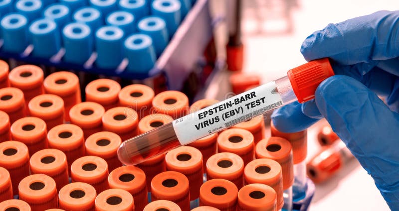 Epstein-Barr Virus EBV Test Tube with Blood Sample in Infection Lab ...