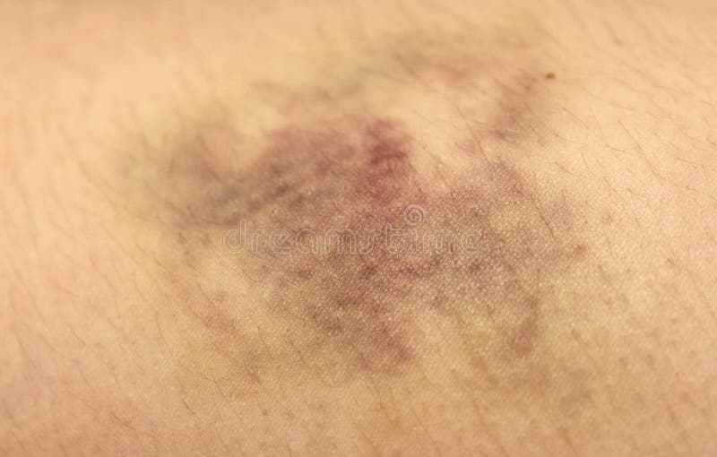 Equimose De Vista Desagradável, Real Imagem de Stock - Imagem de abuso ...