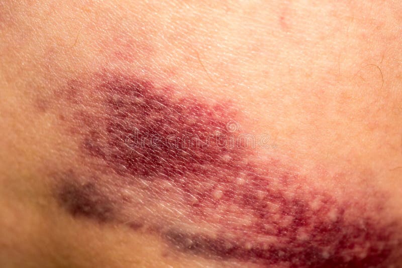 Equimose na pele foto de stock. Imagem de humano, macro - 75750018