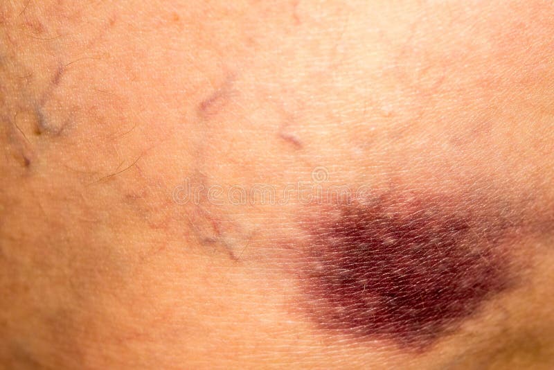 Equimose na pele foto de stock. Imagem de humano, caucasiano - 75750106