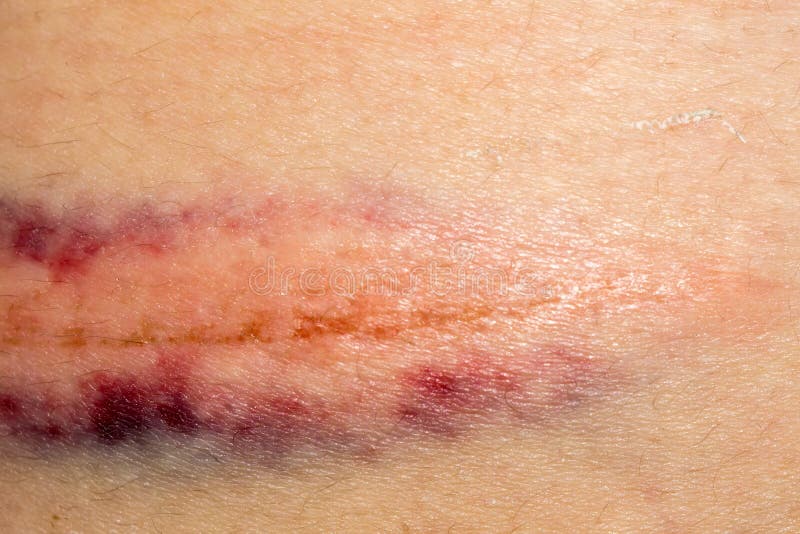 Equimose na pele foto de stock. Imagem de medicina, macro - 99620448
