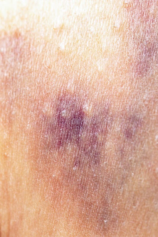 Hematoma Na Pele Das Pernas Imagem de Stock - Imagem de textura ...