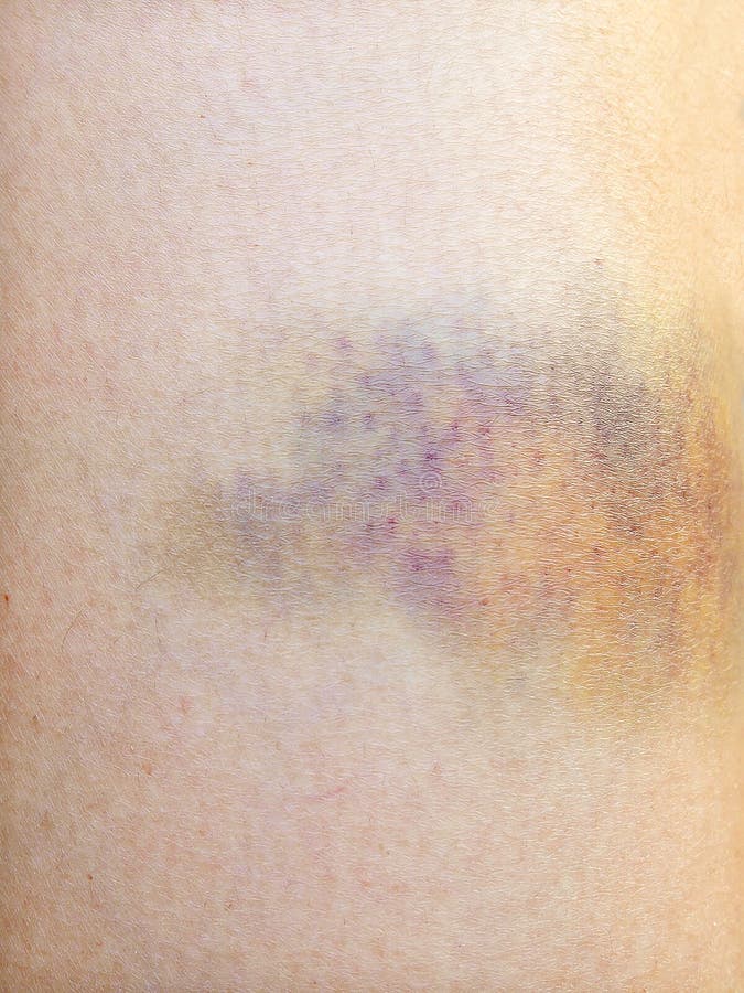 Equimose Em Pele Ferida Fotos - Fotos de Stock Gratuitas e Fotos ...