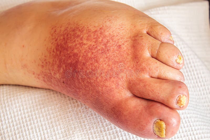 Bacterial Rash
