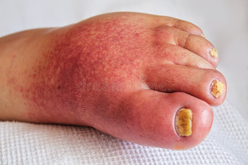 Erysipelas of the Legs, Red Rash on the Legs.selective Focus Stock ...