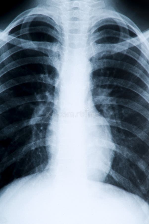 Esame Radiografico Del Torace Immagine Stock - Immagine di scienza ...