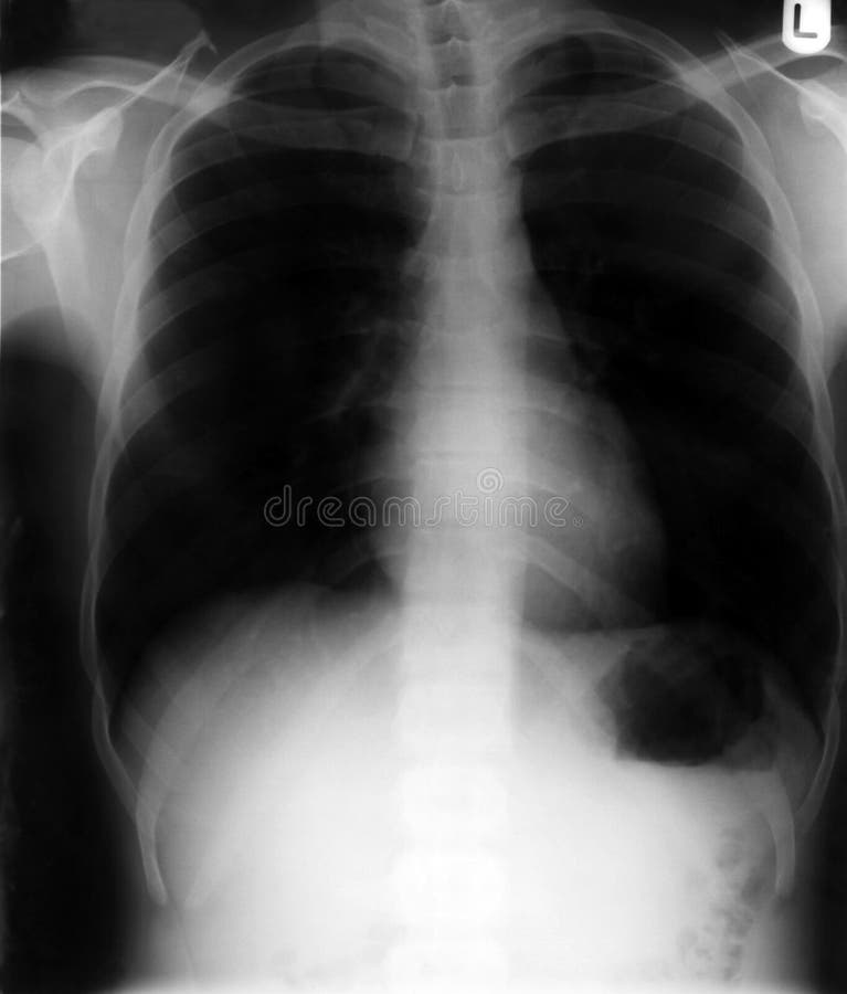 Esame Radiografico Del Torace Fotografia Stock - Immagine di ...