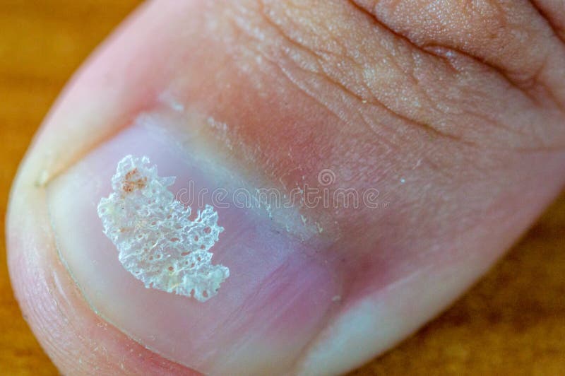 Escama De La Caspa En Clavo Humano Foto de archivo - Imagen de escama ...