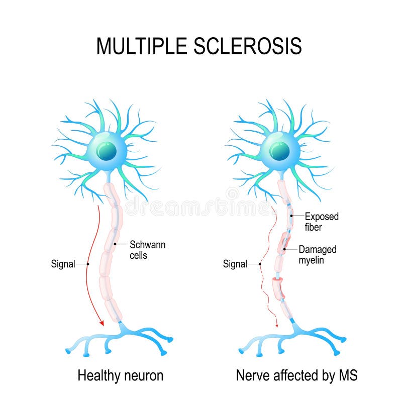 Diagrama Anatómico Del Ejemplo Del Vector De La Esclerosis Múltiple ...