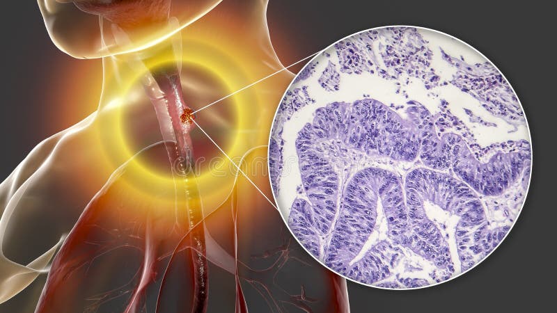 Esophageal Cancer, Illustration and Micrograph Stock Illustration ...
