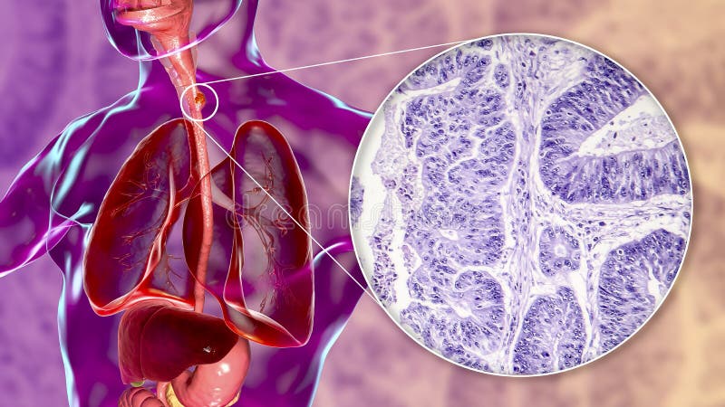Esophageal Cancer, Illustration Stock Illustration - Illustration of ...