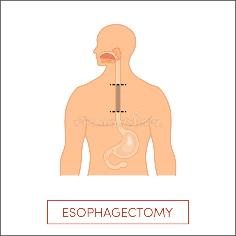 Esophagectomy stock illustration. Illustration of body - 69362665