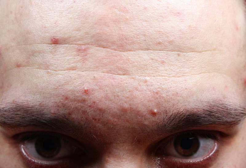 Espinillas Del Acné En La Cara Foto de archivo - Imagen de molestia ...