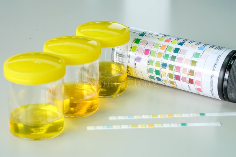 Essai de bande d'urine photo stock. Image du diabétique - 92189656