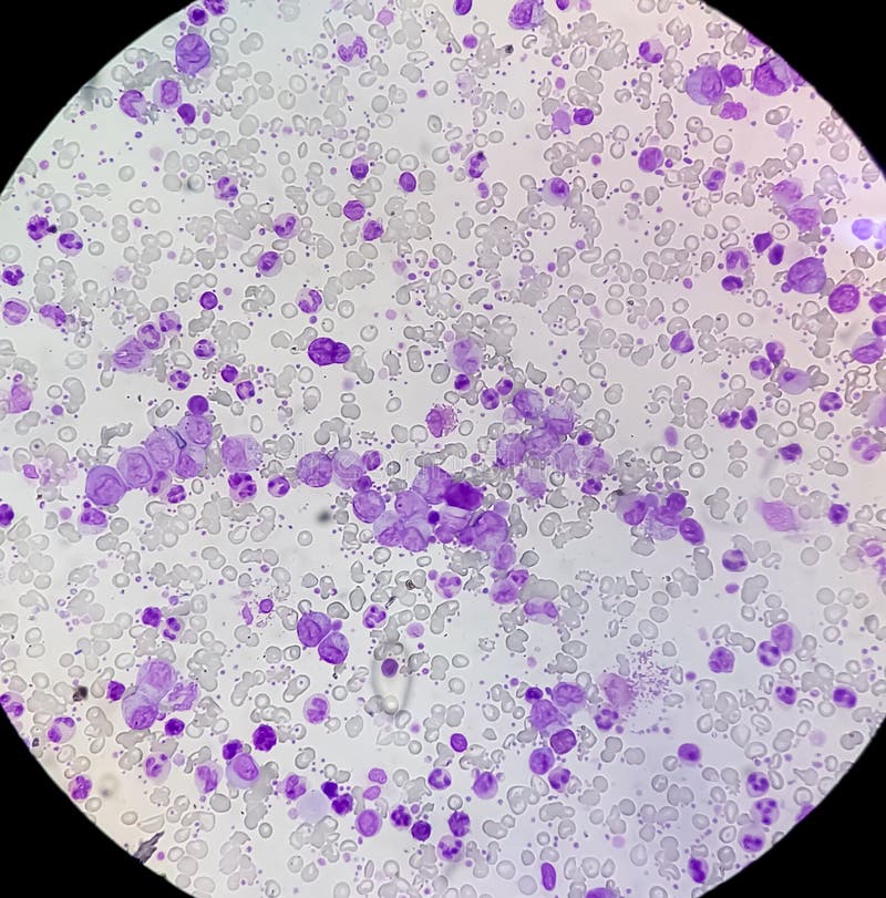Essential Thrombocytosis Blood Smear Showing Abnormal High Volume of ...
