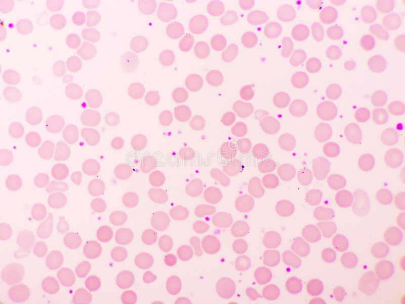 Essential Thrombocytosis Blood Smear Stock Image - Image of medical ... Essential Thrombocytosis Blood Smear Stock Image - Image of medical ...