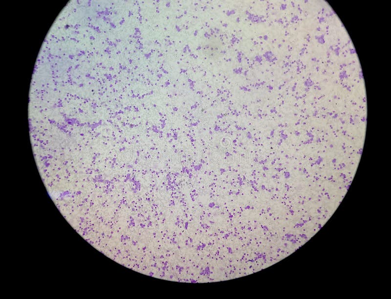 Essential Thrombocytosis Under Microscopy, Abnormal High Volume of ...