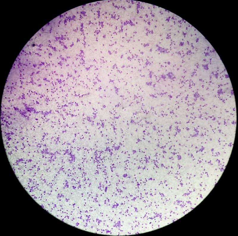 Essential Thrombocytosis Under Microscopy, Abnormal High Volume of ...