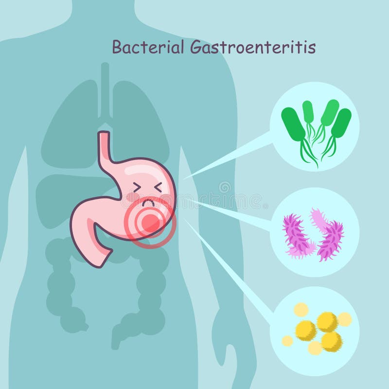 Estómago Con Gastroenteritis Bacteriana Ilustración del Vector ...