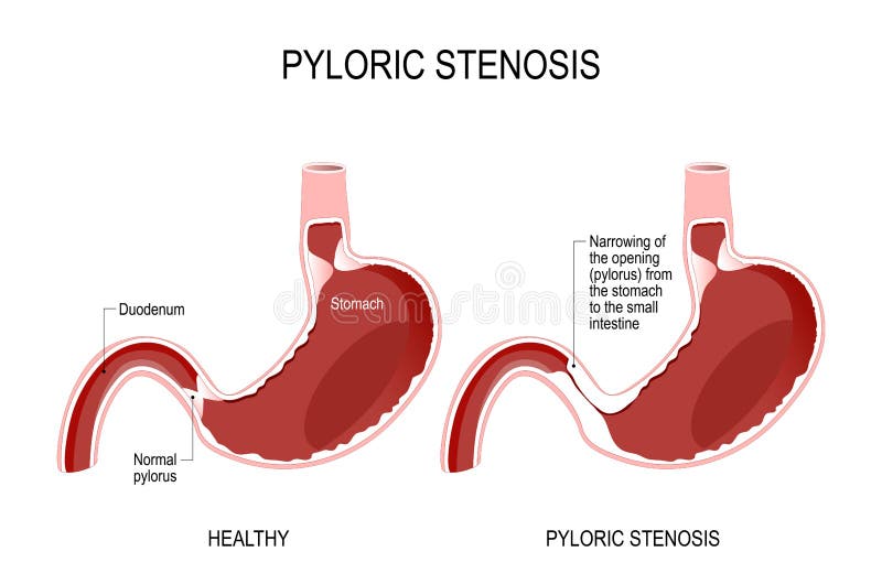 Esfínter Pilórico Del Duodeno Del Estómago Píloro Infografía Imagen Del ...