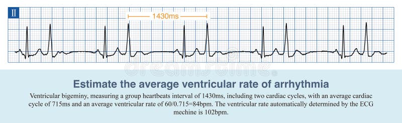 Average Ventricular Rate Stock Photos - Free & Royalty-Free Stock ...