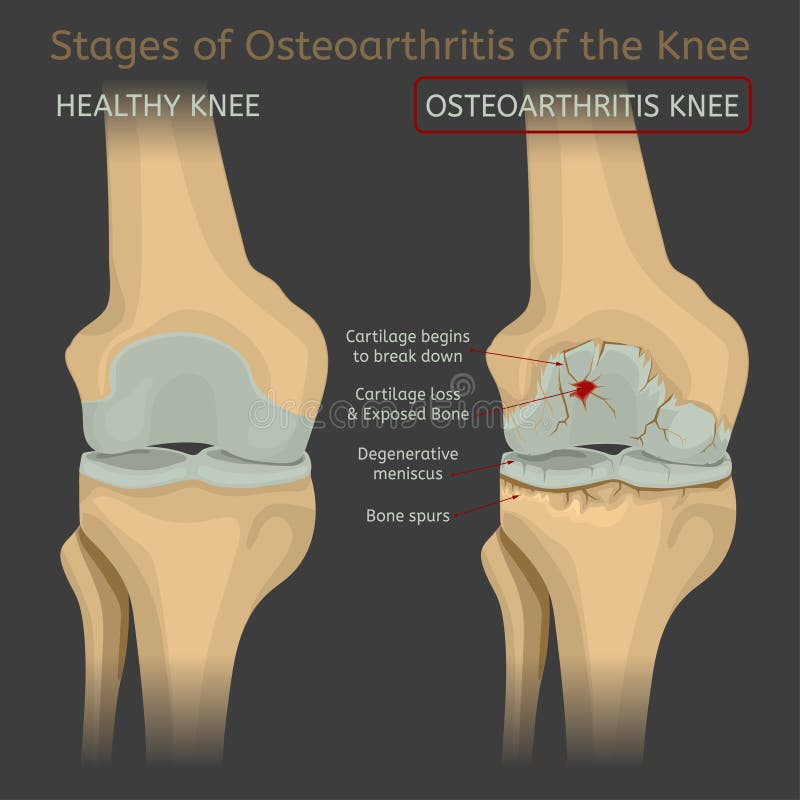 Osteoartritis De La Rodilla Ilustración del Vector - Ilustración de ... Osteoartritis De La Rodilla Ilustración del Vector - Ilustración de ...