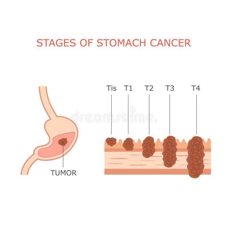 Etapas Del Cáncer De Estómago, Ilustración del Vector - Ilustración de ...