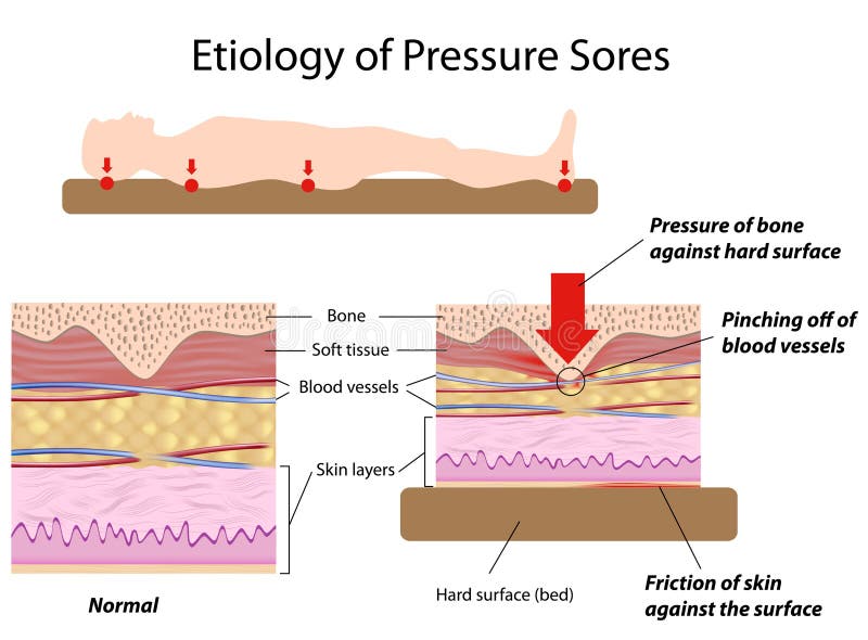 Pressure Ulcer Stock Illustrations – 159 Pressure Ulcer Stock ...
