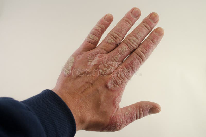 Exacerbación Del Psoriasis En Las Manos Imagen de archivo - Imagen de ...