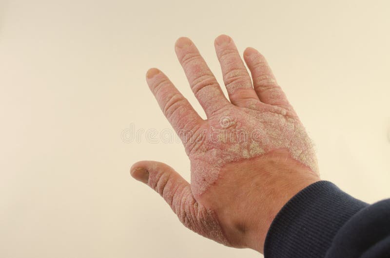 Exacerbación Del Psoriasis En Las Manos Imagen de archivo - Imagen de ...
