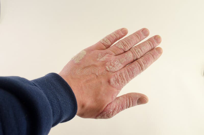 Psoriasis En Los Huesos De Mano - Primer Imagen de archivo - Imagen de ...
