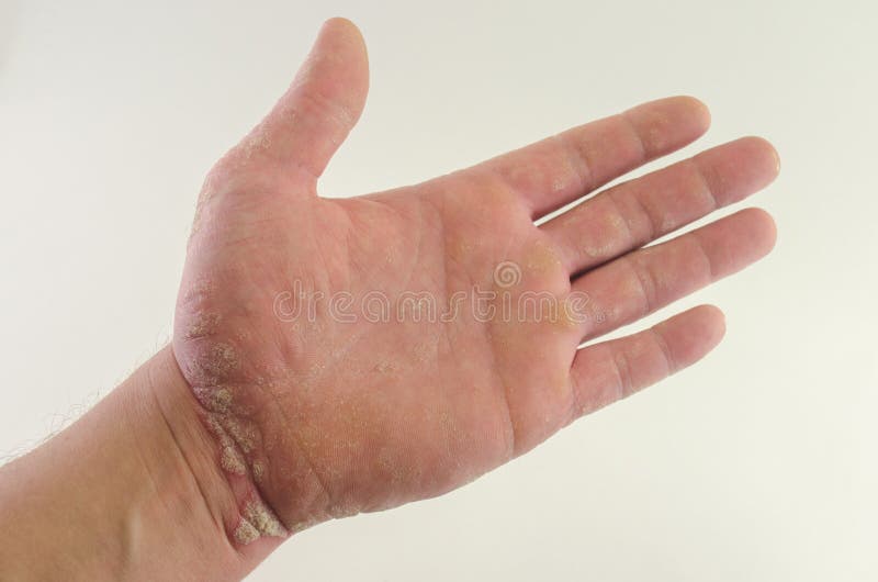 Psoriasis Sur Les Mains Et Les Ongles Image stock - Image du blanc ...
