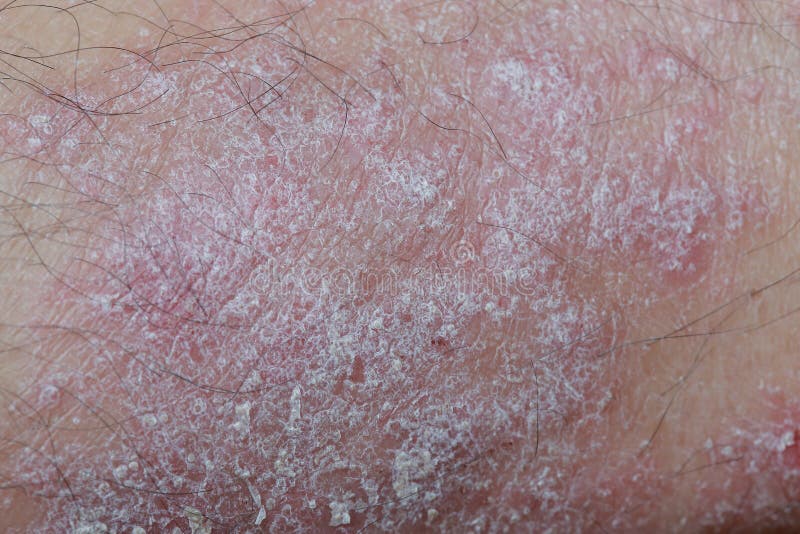 Exacerbation of psoriasis. stock image. Image of baking - 248669075