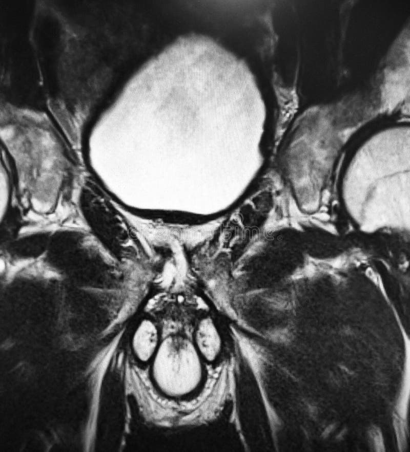 Exame Urological Do Mri Do Epididimit Da Patologia Foto de Stock ...